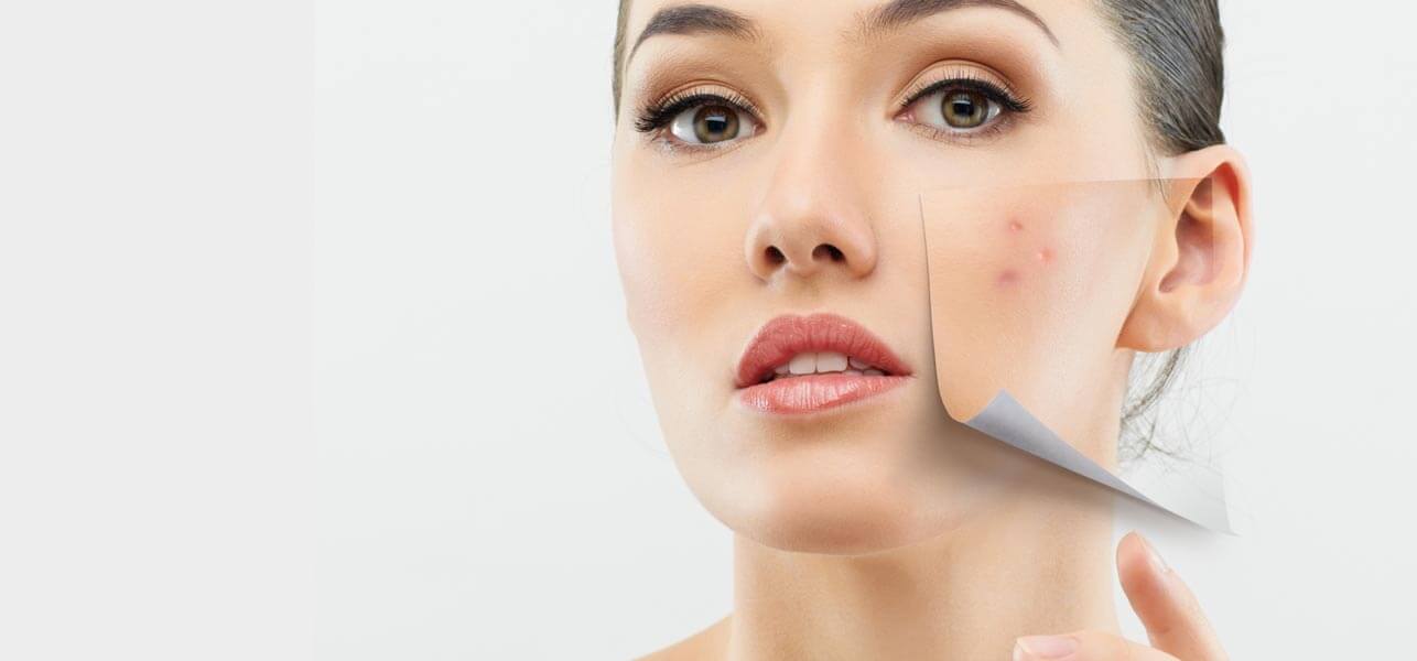 THE SKIN BEFORE AND AFTER ACNE REMOVAL BY THE EXPERTS